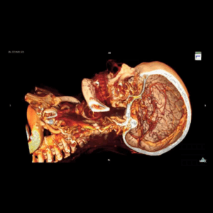 Contrast vs. Non-Contrast CT Scans | MXR Imaging
